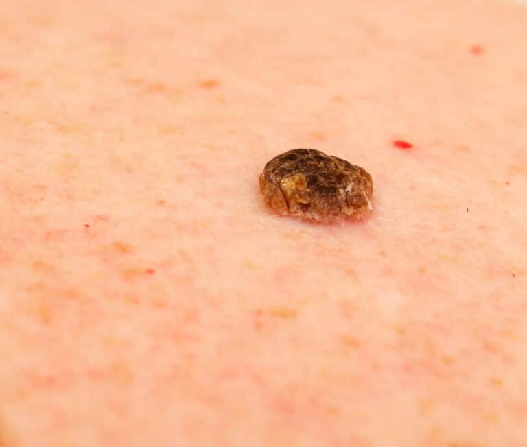 Kératose séborrhéique : causes et traitements |Skin Marceau | Paris