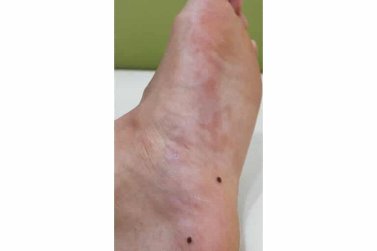 Traitement des verrues à Paris | Laser Dermatologique | Skin Marceau