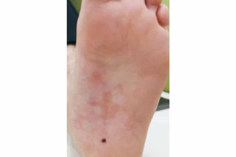 Traitement des verrues à Paris | Laser Dermatologique | Skin Marceau