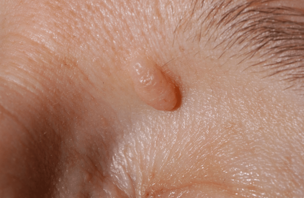 Grains de beauté : Guide complet sur les différents types de nævi