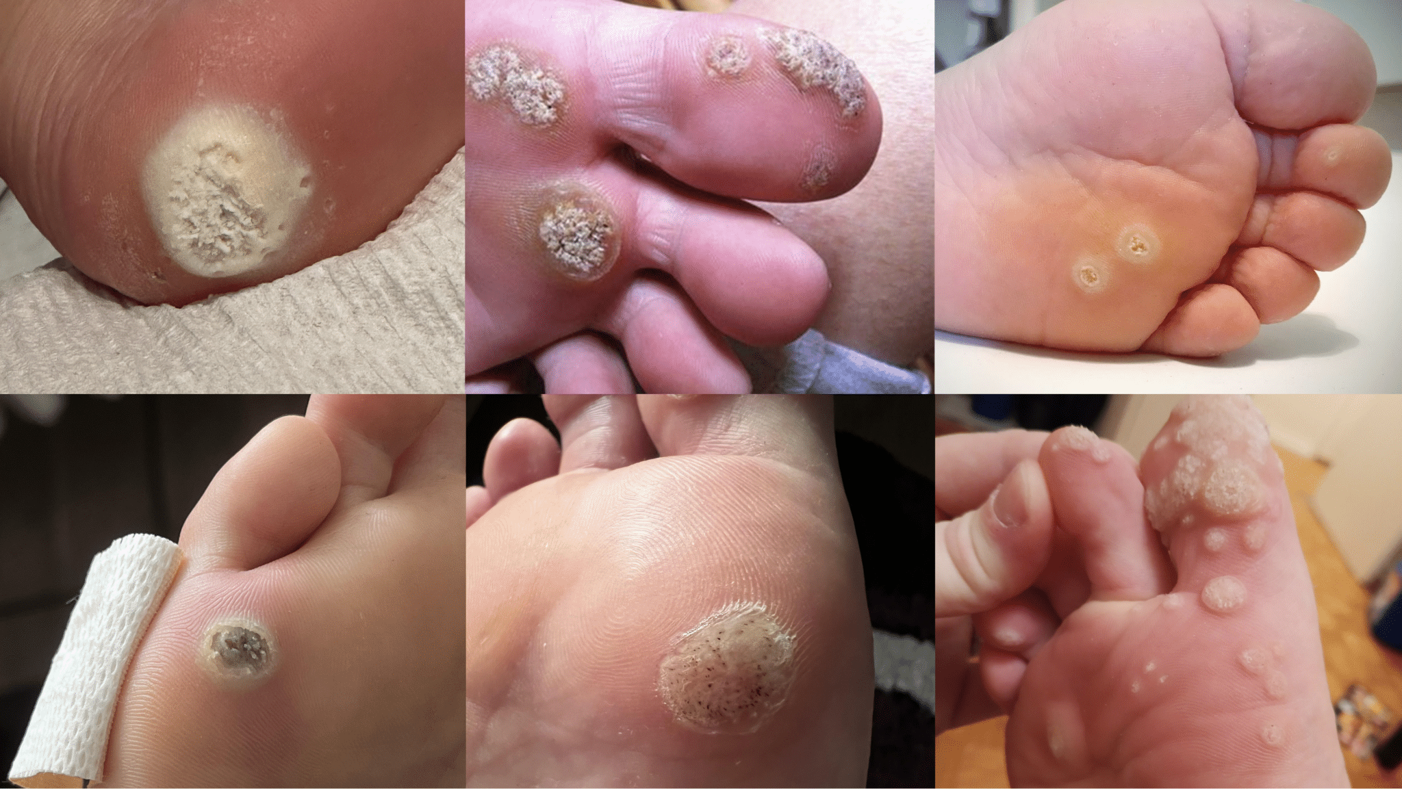 Verrue Plantaire : photos, définition, symptômes et traitements