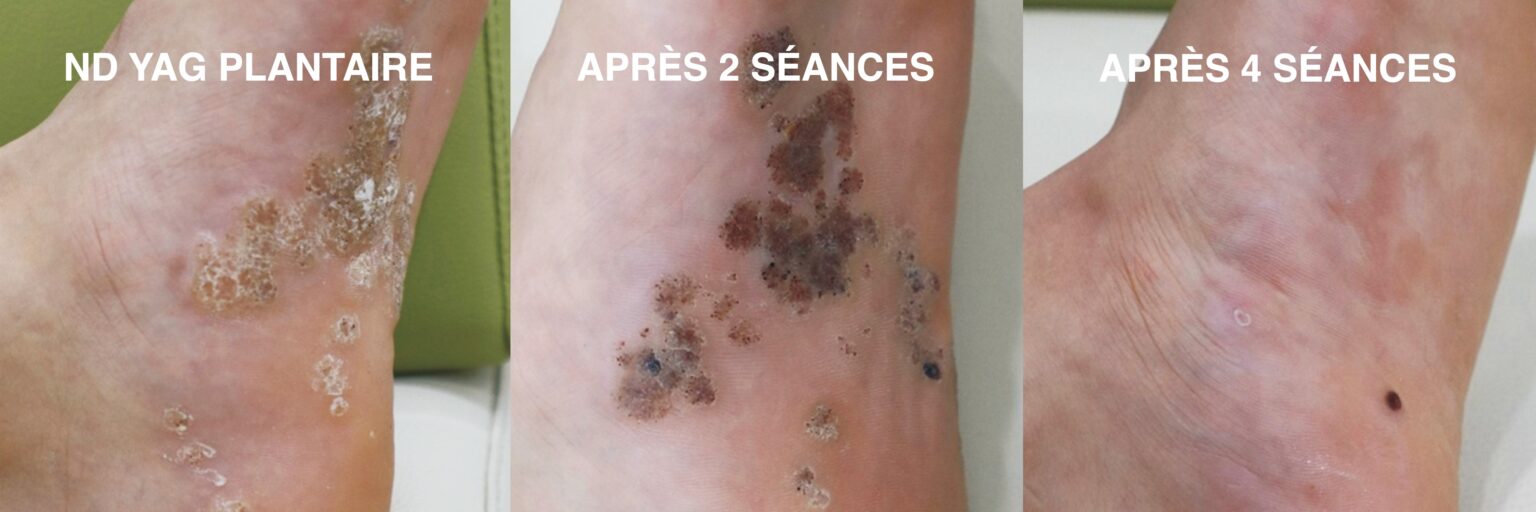 Verrue Plantaire : photos, définition, symptômes et traitements