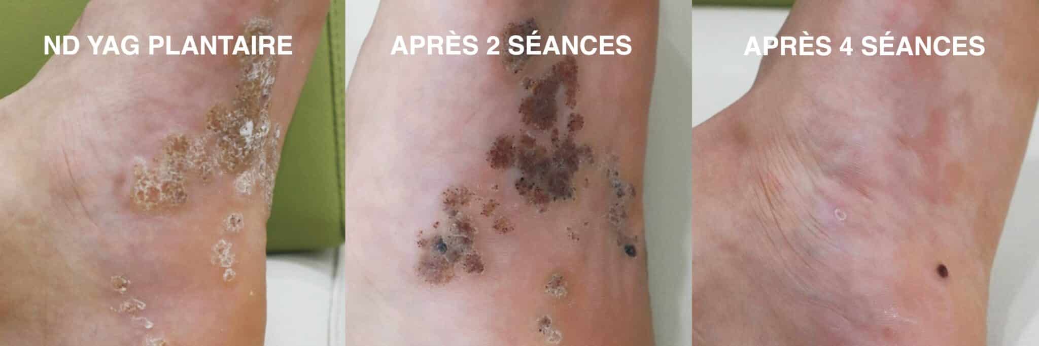 Verrue Plantaire : photos, définition, symptômes et traitements