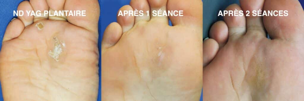 Verrue Plantaire : photos, définition, symptômes et traitements