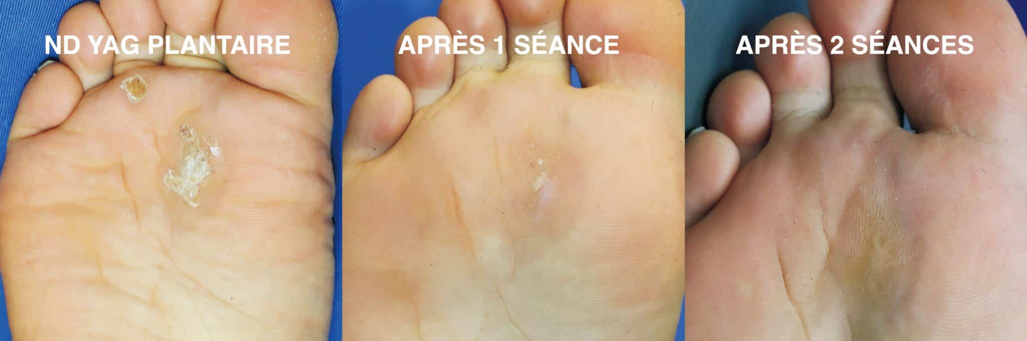 Verrue Plantaire : photos, définition, symptômes et traitements