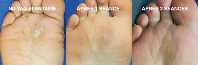 Verrue Plantaire : photos, définition, symptômes et traitements