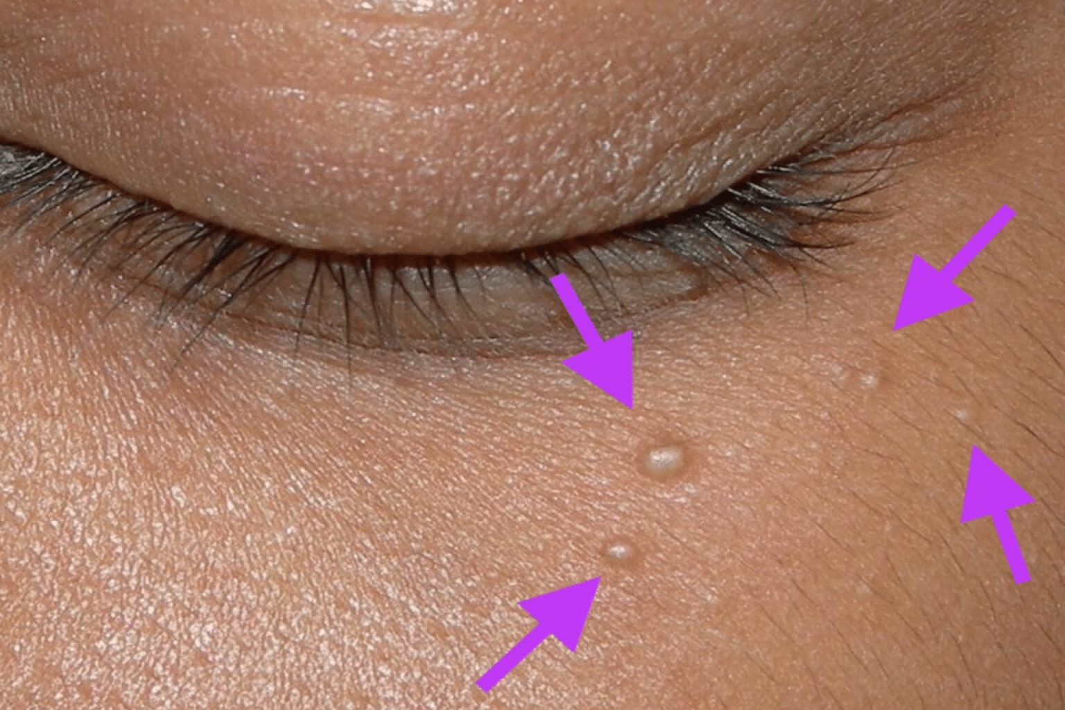 Grains de milium : Comment s'en débarrasser