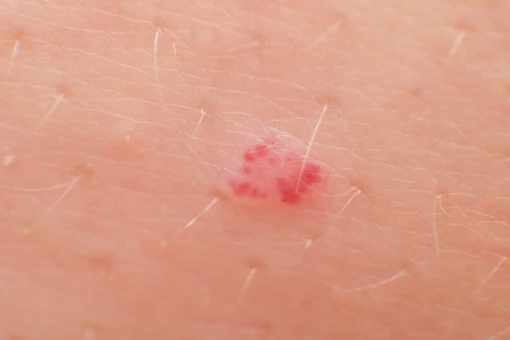 Traitement de l'angiome à Paris | Clinique dermatologie esthétique ...