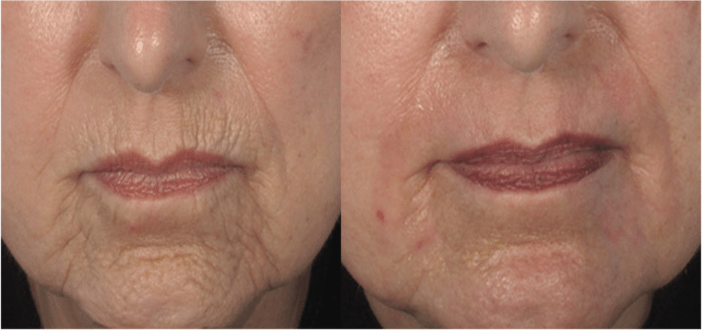 ULTRApulse Alpha | Le laser CO2 le plus avancé