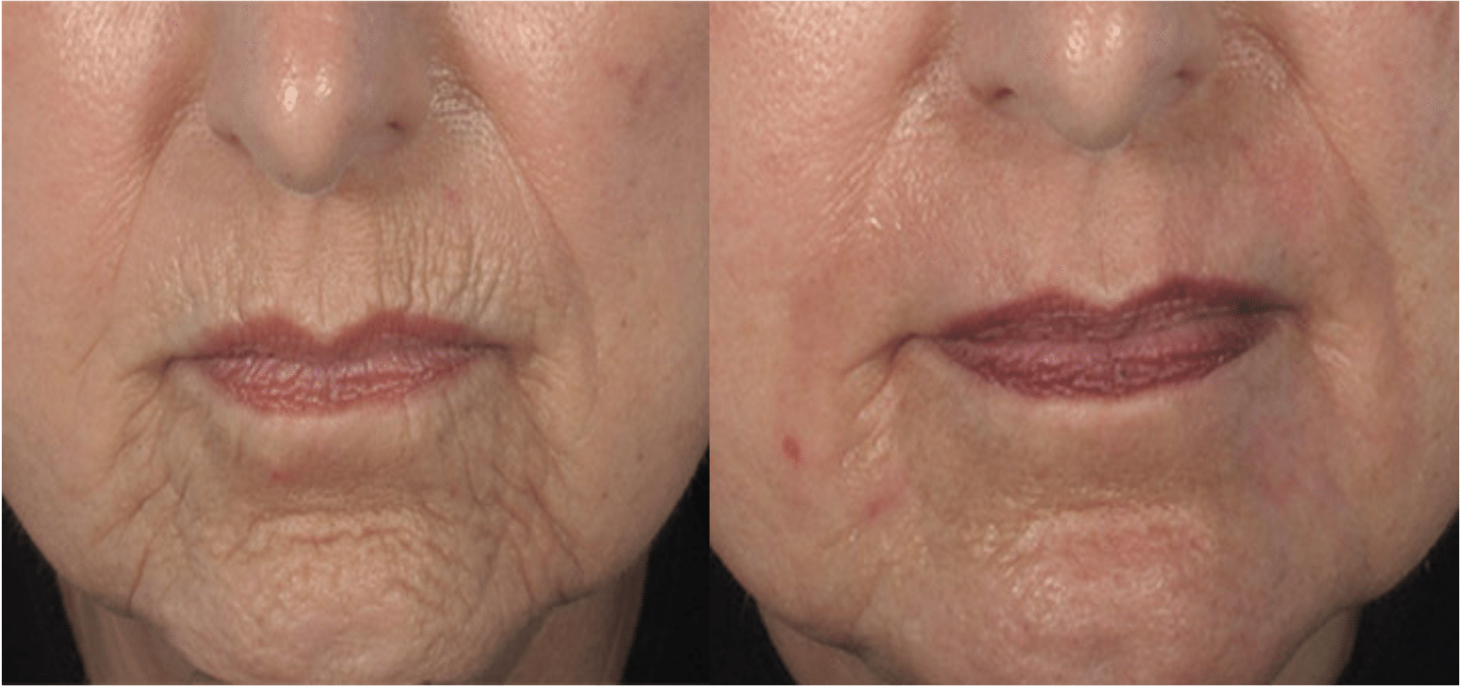 Traitement laser CO2 fractionné à Paris | Dermatologue esthétique ...