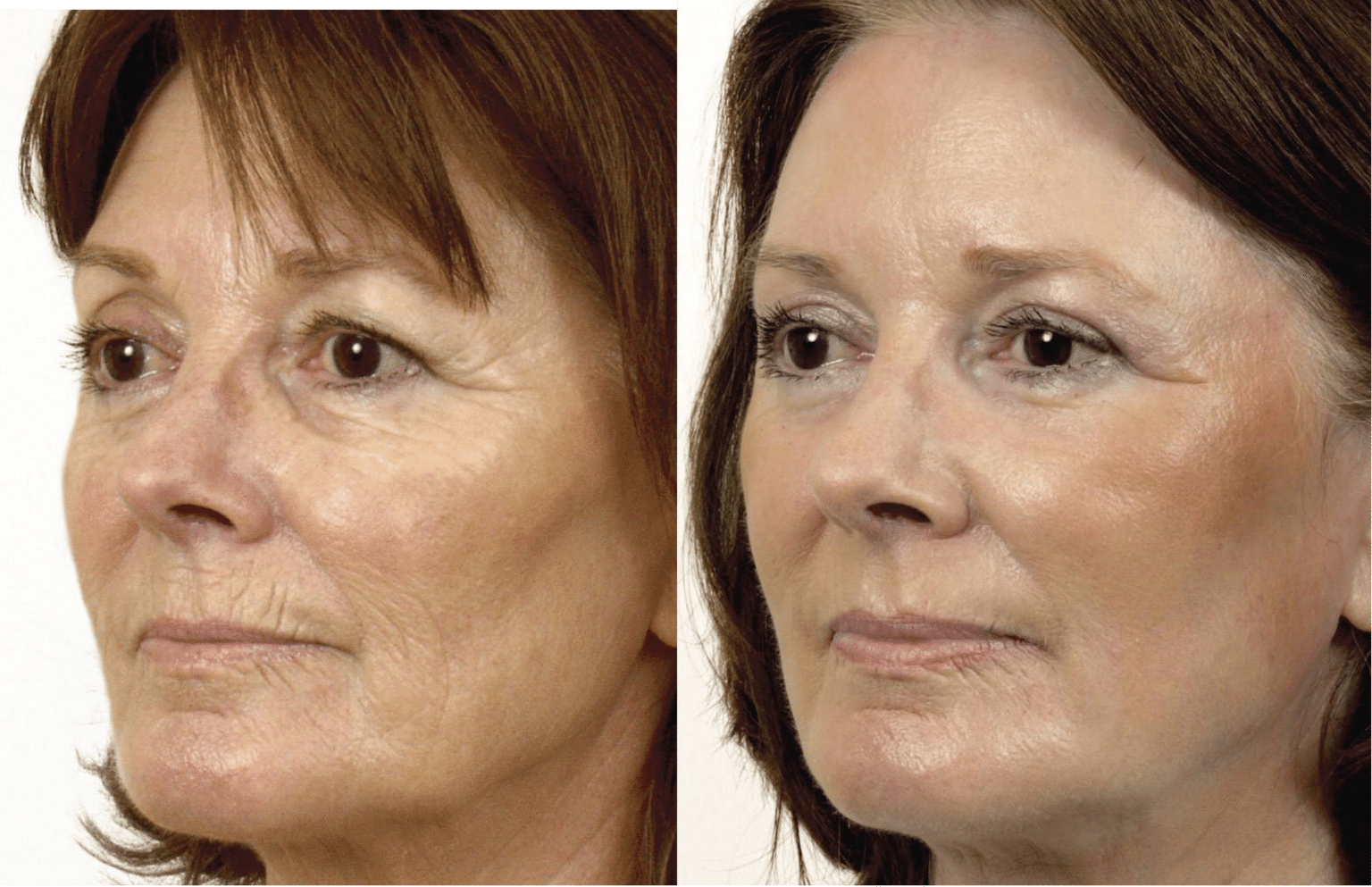 Traitement laser CO2 fractionné à Paris | Dermatologue esthétique ...