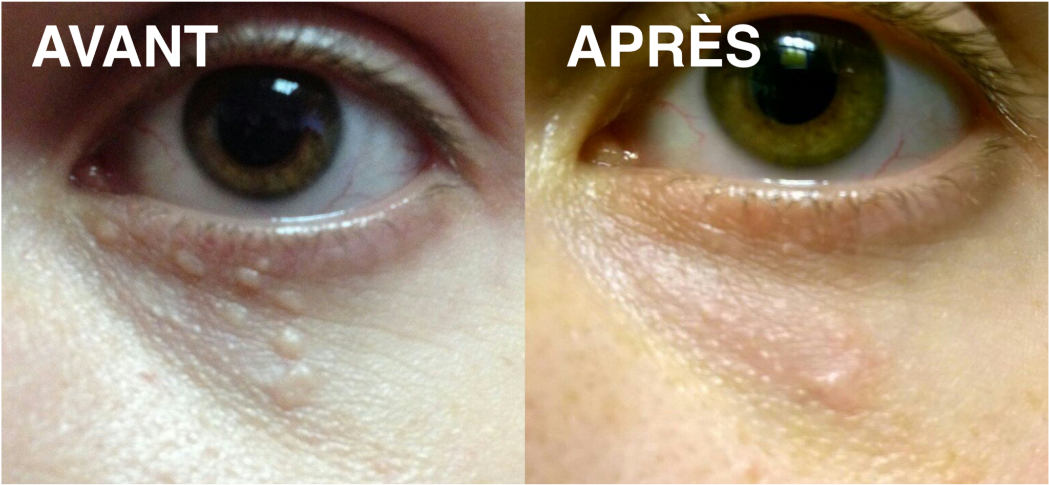 Traitement des syringomes à Paris | Dermatologue | Skin Marceau