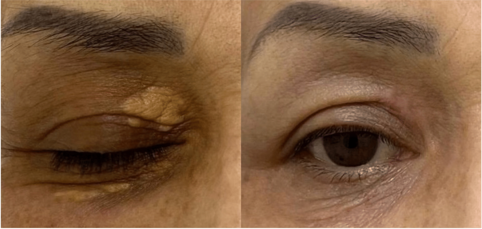 Traitement des xanthelasmas à Paris | Clinique dermatologie esthétique ...