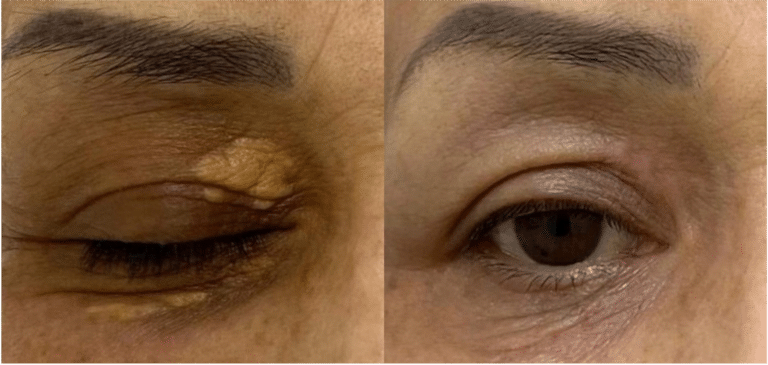 Laser CO2 Avant Après | Dermatologue Esthétique | Skin Marceau