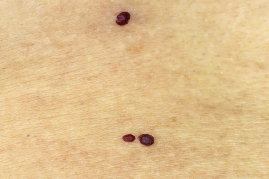 Traitement de l'angiome à Paris | Clinique dermatologie esthétique ...