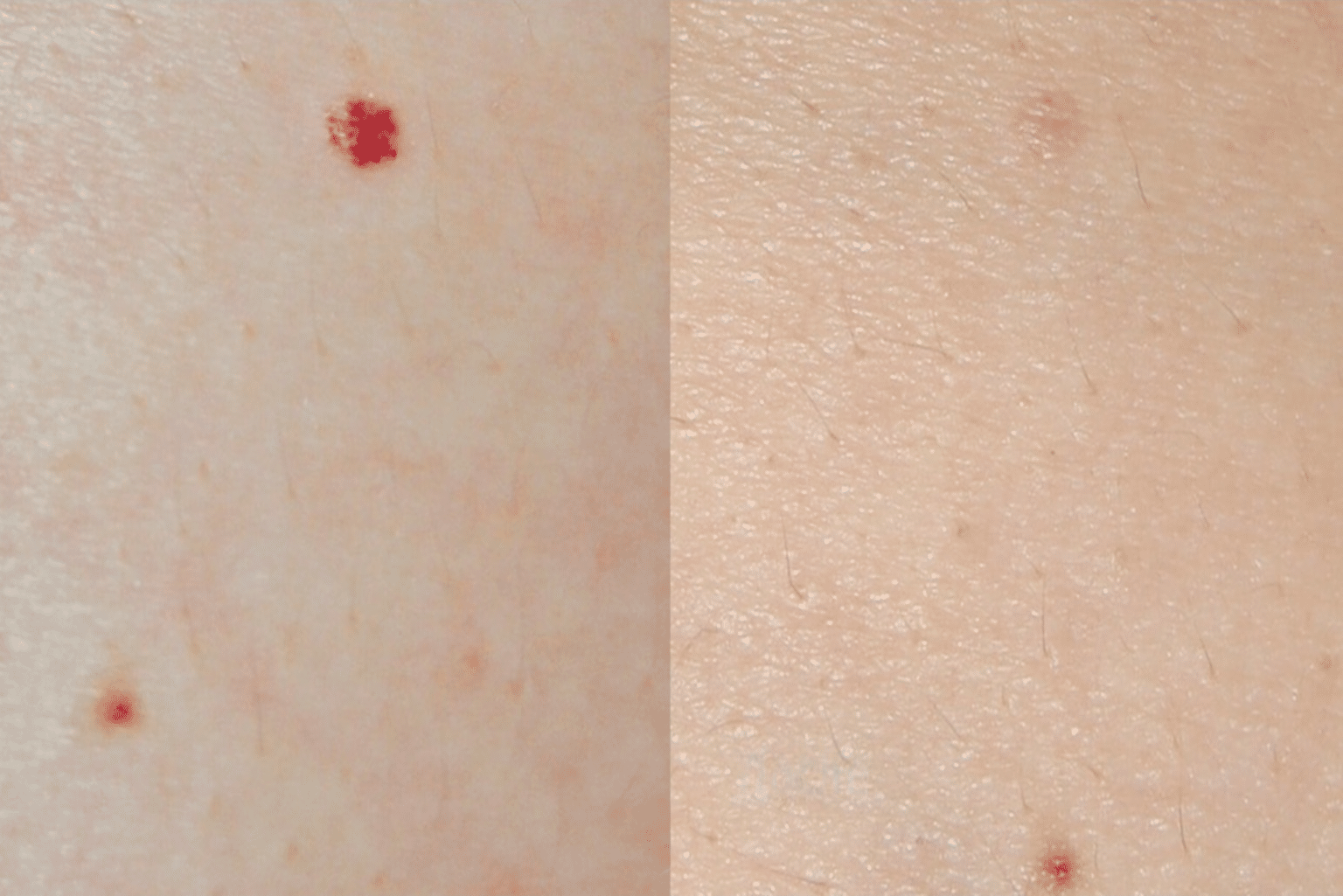 Traitement de l'angiome à Paris | Clinique dermatologie esthétique ...