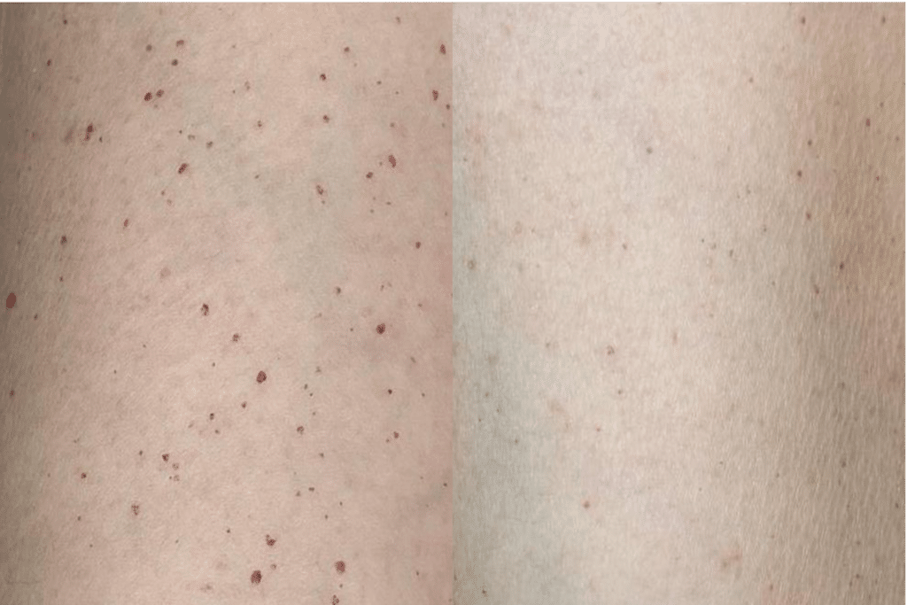 Traitement de l'angiome à Paris | Clinique dermatologie esthétique ...