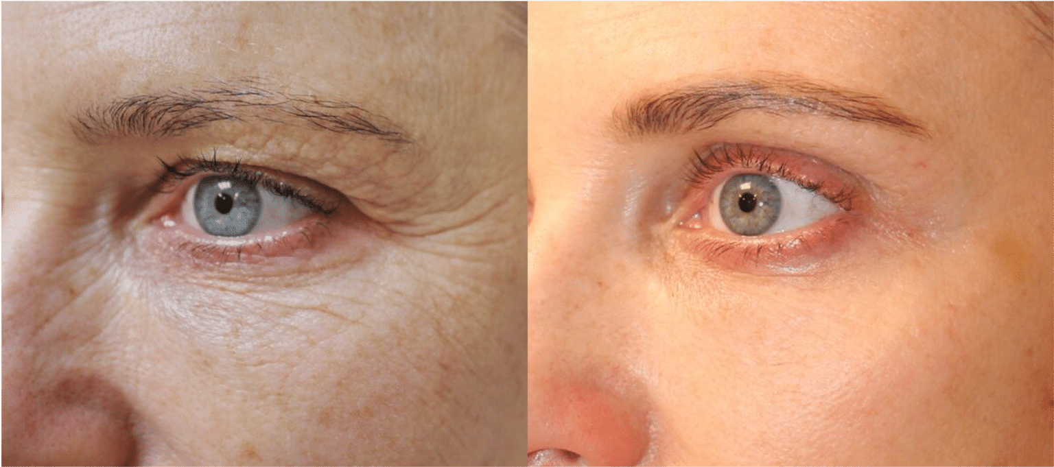 ULTRApulse Alpha | Le laser CO2 le plus avancé