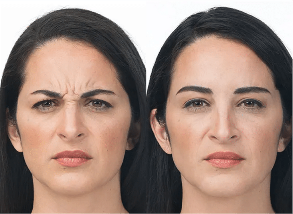 Botox Visage Avant Après | Dermatologue | Skin Marceau