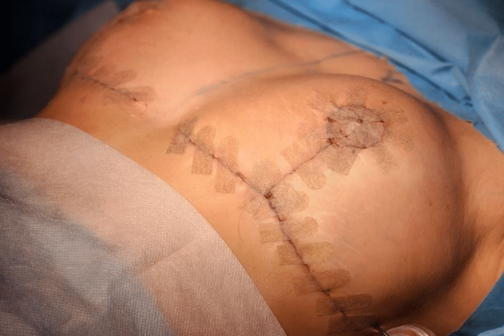 Cicatrices réduction mammaire : Laser Traitement à Paris