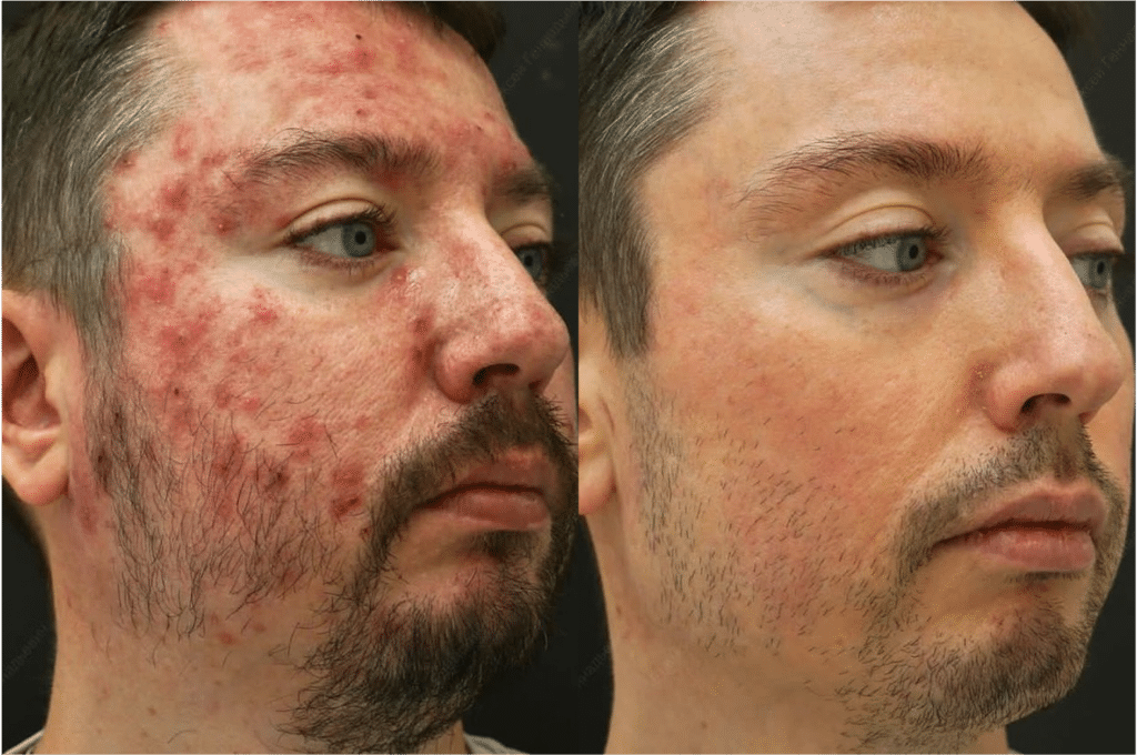 Laser Couperose Visage : Résultats Avant et Après | Skin Marceau
