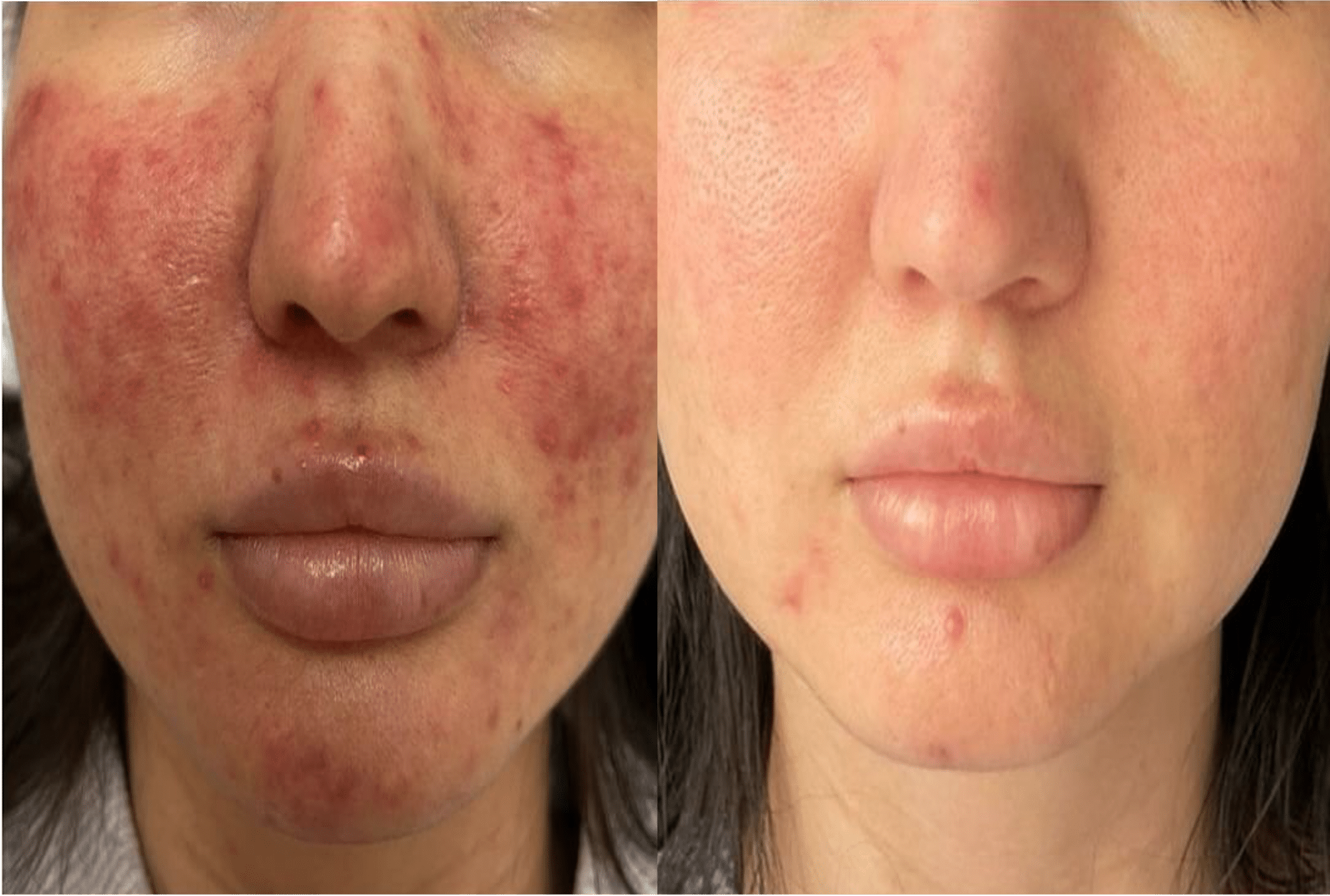 Laser Couperose Visage : Résultats Avant et Après | Skin Marceau