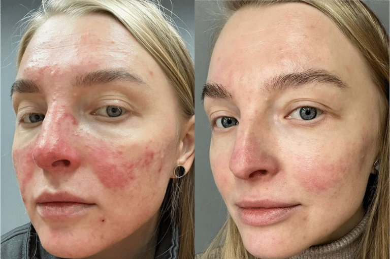 Photos : Couperose / Rosacée sur le visage et le nez | Skin Marceau
