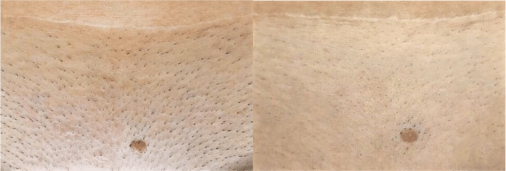 Épilation du Maillot Photos : Brésilien, Intégral et Ticket de Métro