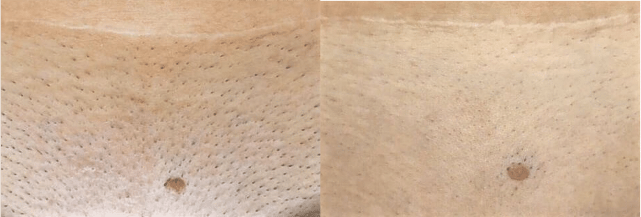 Épilation du Maillot Photos : Brésilien, Intégral et Ticket de Métro