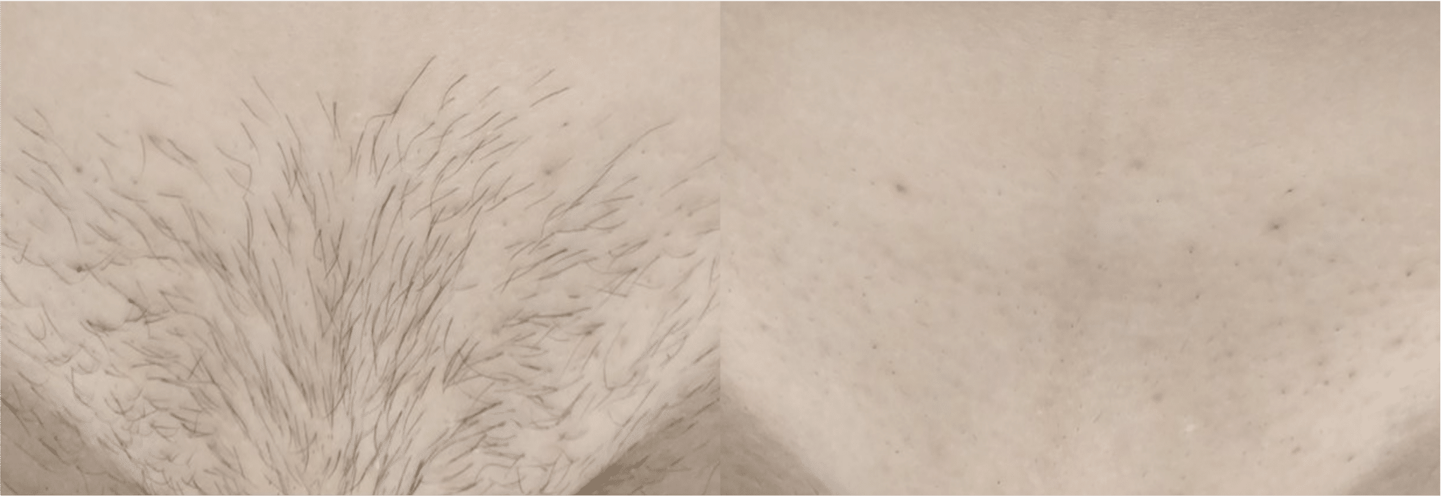 Tout savoir sur l’épilation du SIF (Sillon Interfessier)