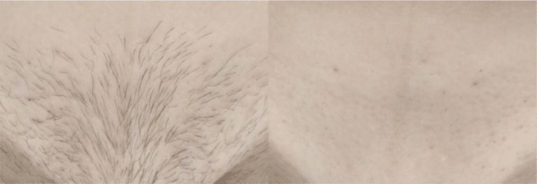 Tout savoir sur l’épilation du SIF (Sillon Interfessier)