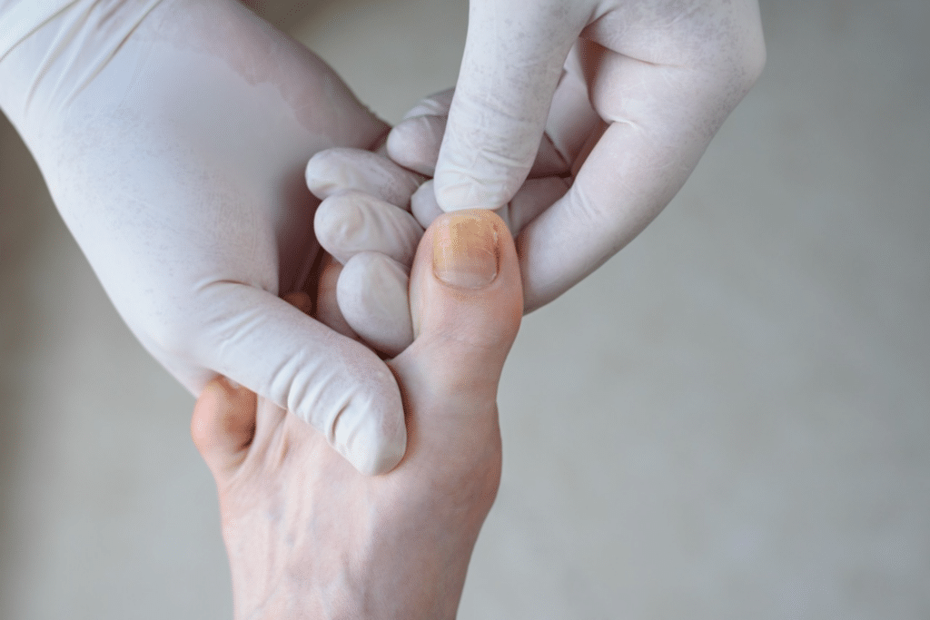 Mycoses des Ongles (pieds et mains) : photos, traitements, symptômes et causes