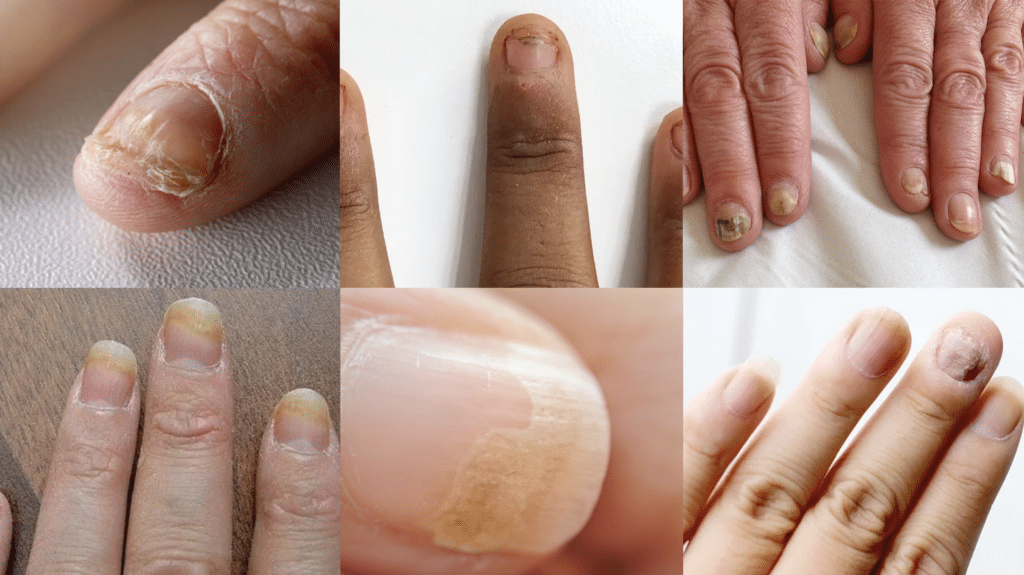 Mycoses des Ongles (pieds et mains) : photos, traitements, symptômes et ...