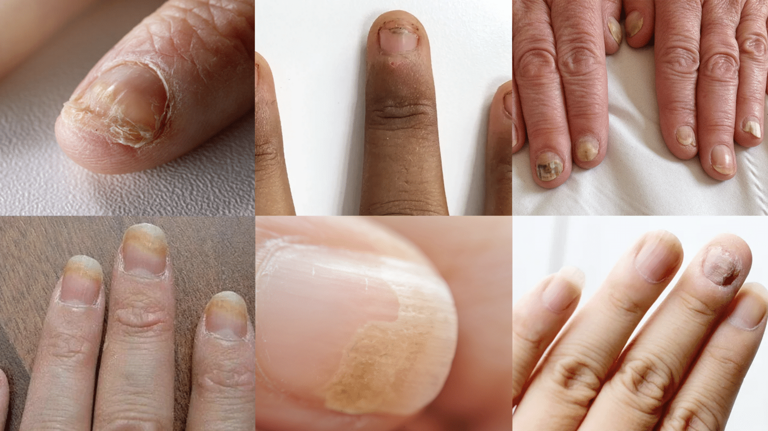 Mycoses des Ongles (pieds et mains) : photos, traitements, symptômes et causes