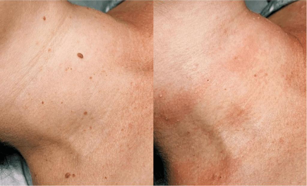 Traitement des excroissances de la peau à Paris | Clinique Skin Marceau