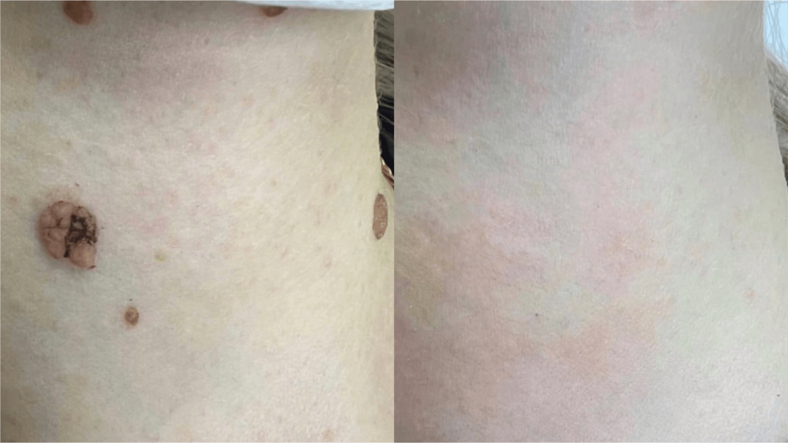 Traitement des excroissances de la peau à Paris | Clinique Skin Marceau