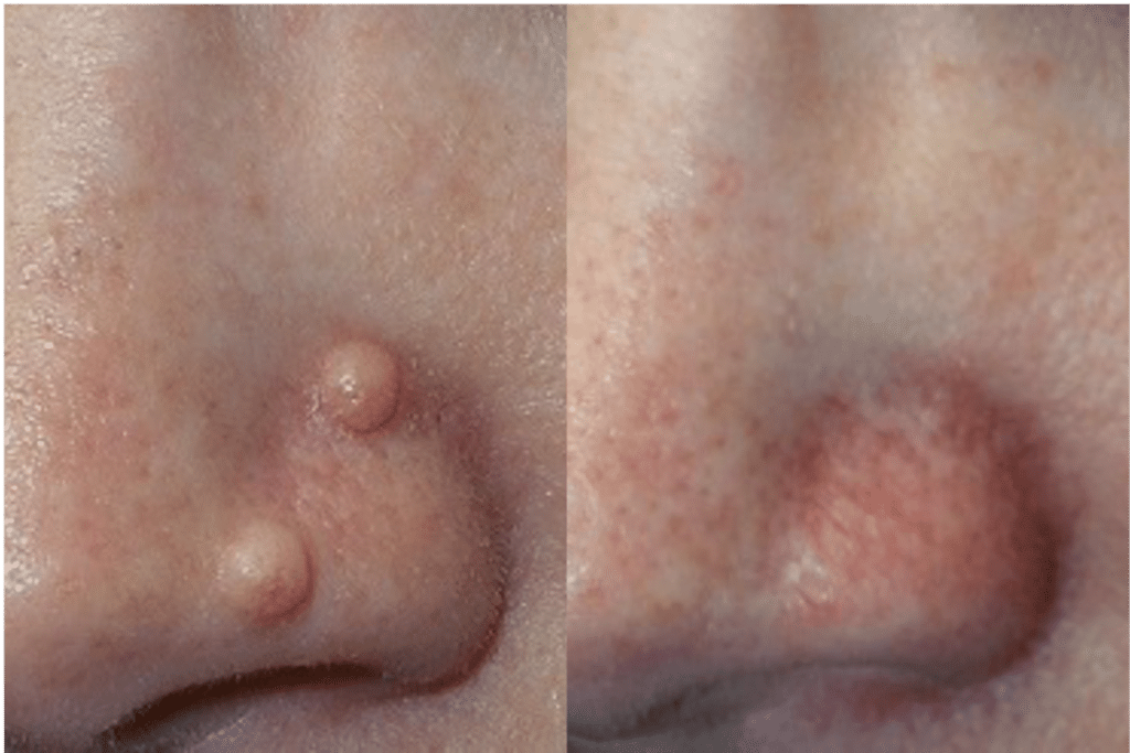 Bouton sur le nez : Photos et Traitement