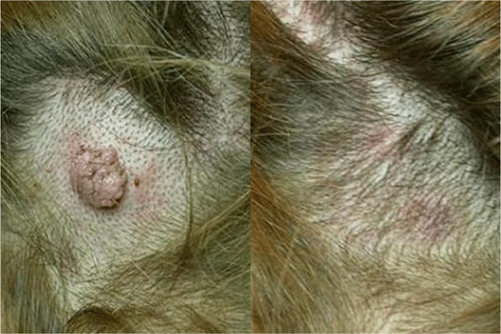 Naevus du Cuir Chevelu : Enlever au laser sans cicatrice