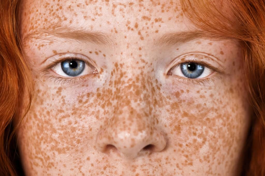 Les taches de rousseur : Comment les effacer