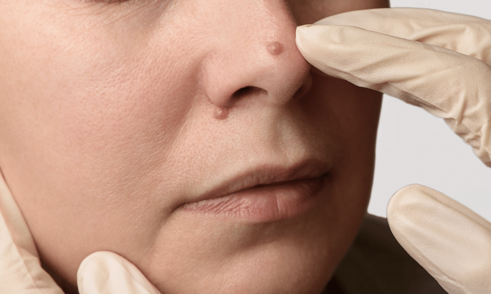 Bouton sur le nez : Photos et Traitement