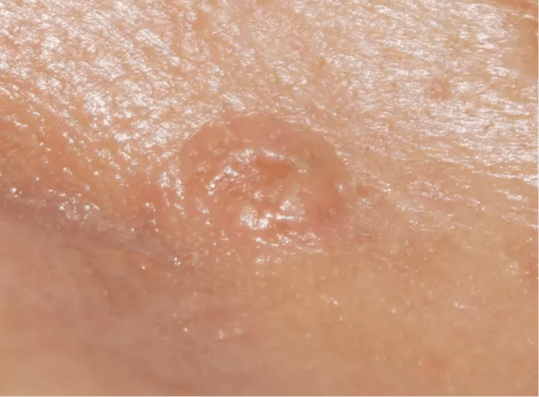 Bouton sur le nez : Photos et Traitement