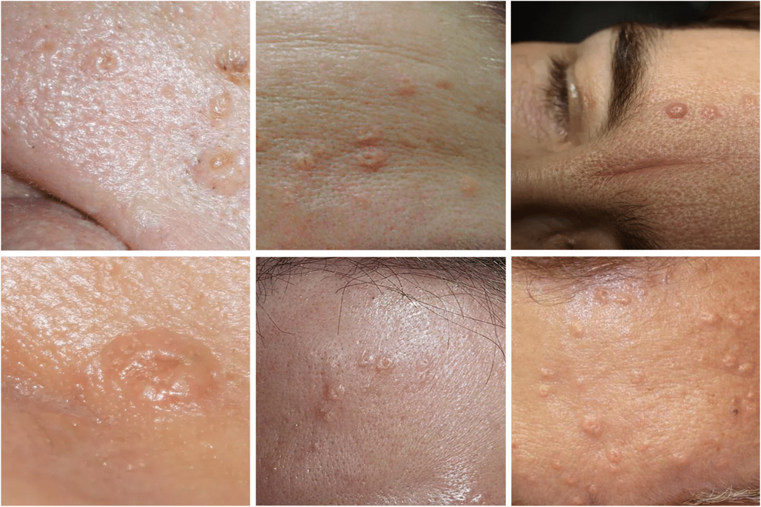 Hyperplasie Sébacée : Causes, Photos et Traitement au Laser