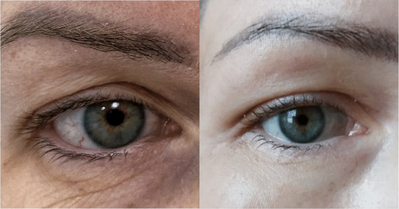 Laser eyelid tightening | Skin Marceau | Paris 16