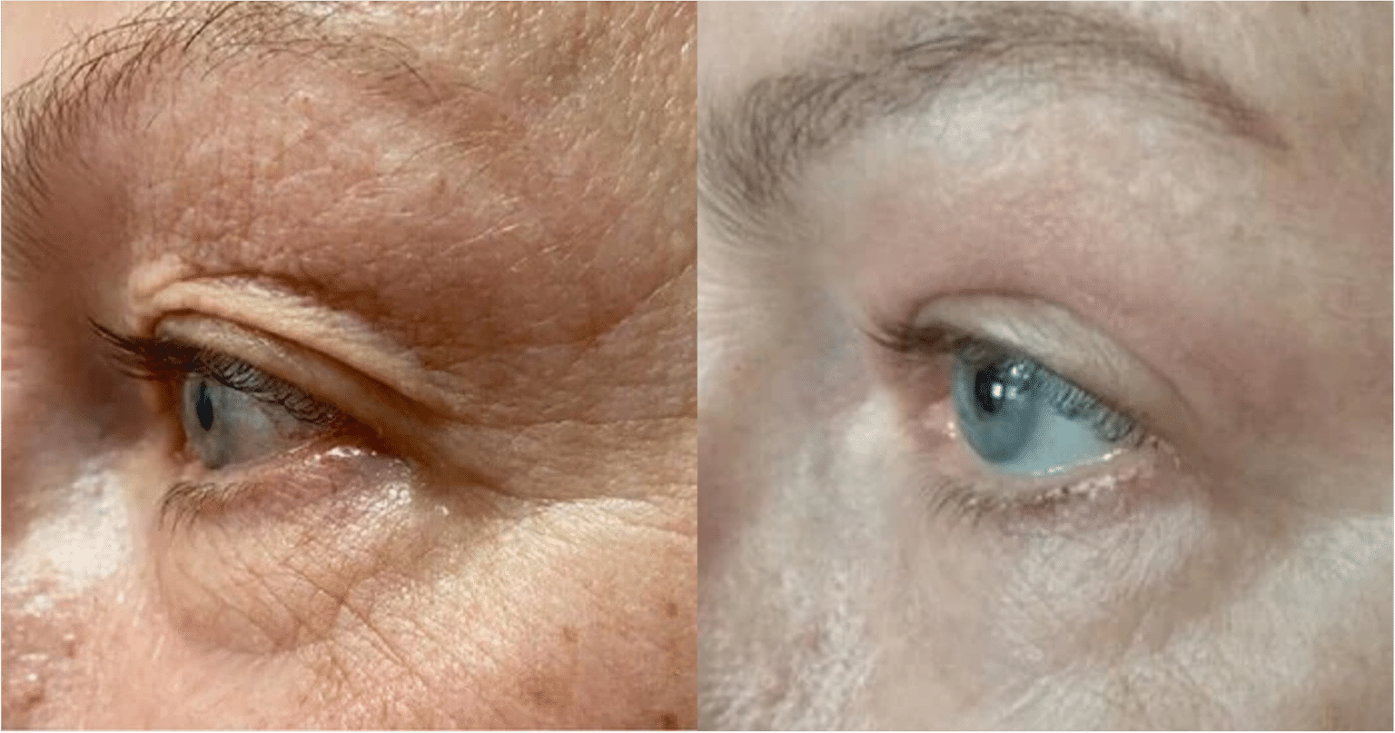 Laser eyelid tightening | Skin Marceau | Paris 16