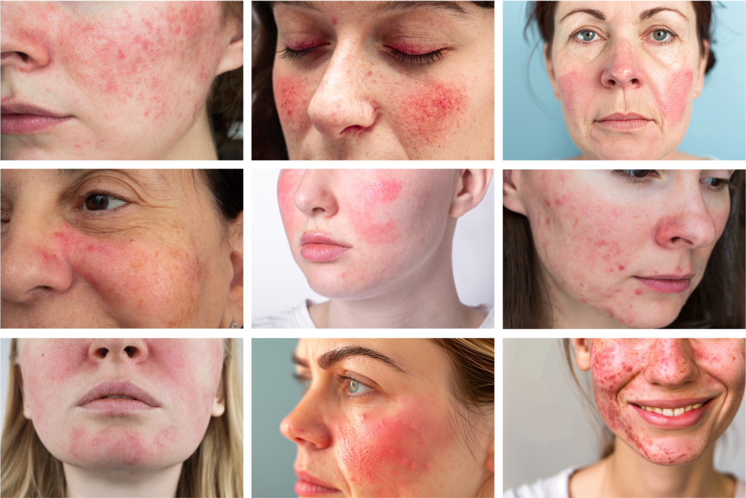 Laser Couperose Visage : Effets Secondaires à Connaître