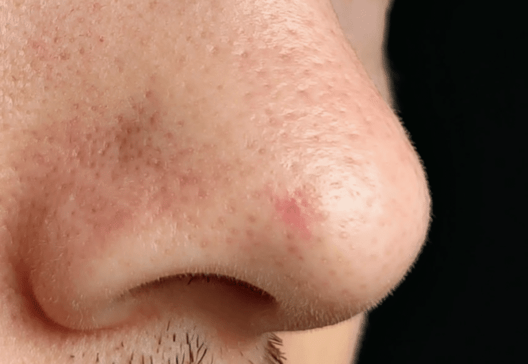 Bouton sur le nez : Photos et Traitement