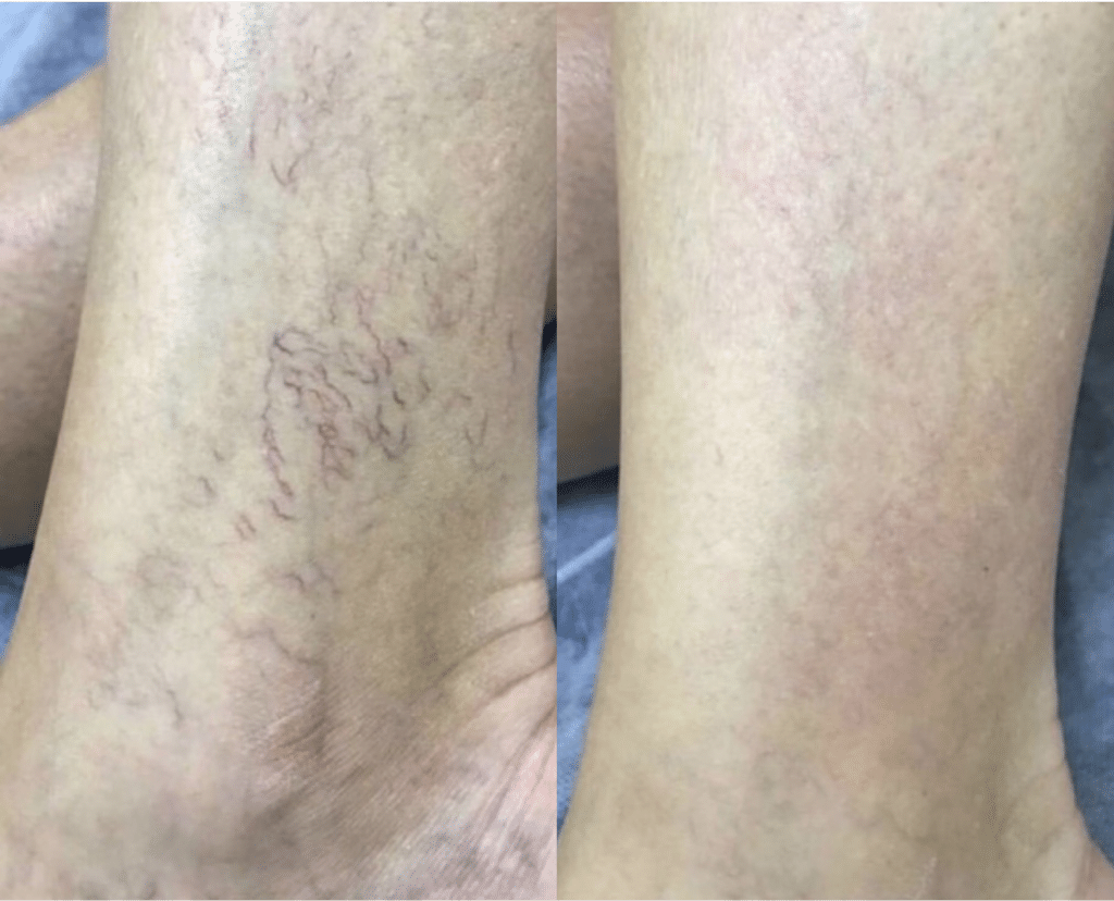 Varicosités des Jambes : Photos Avant-Après et Traitement au Laser