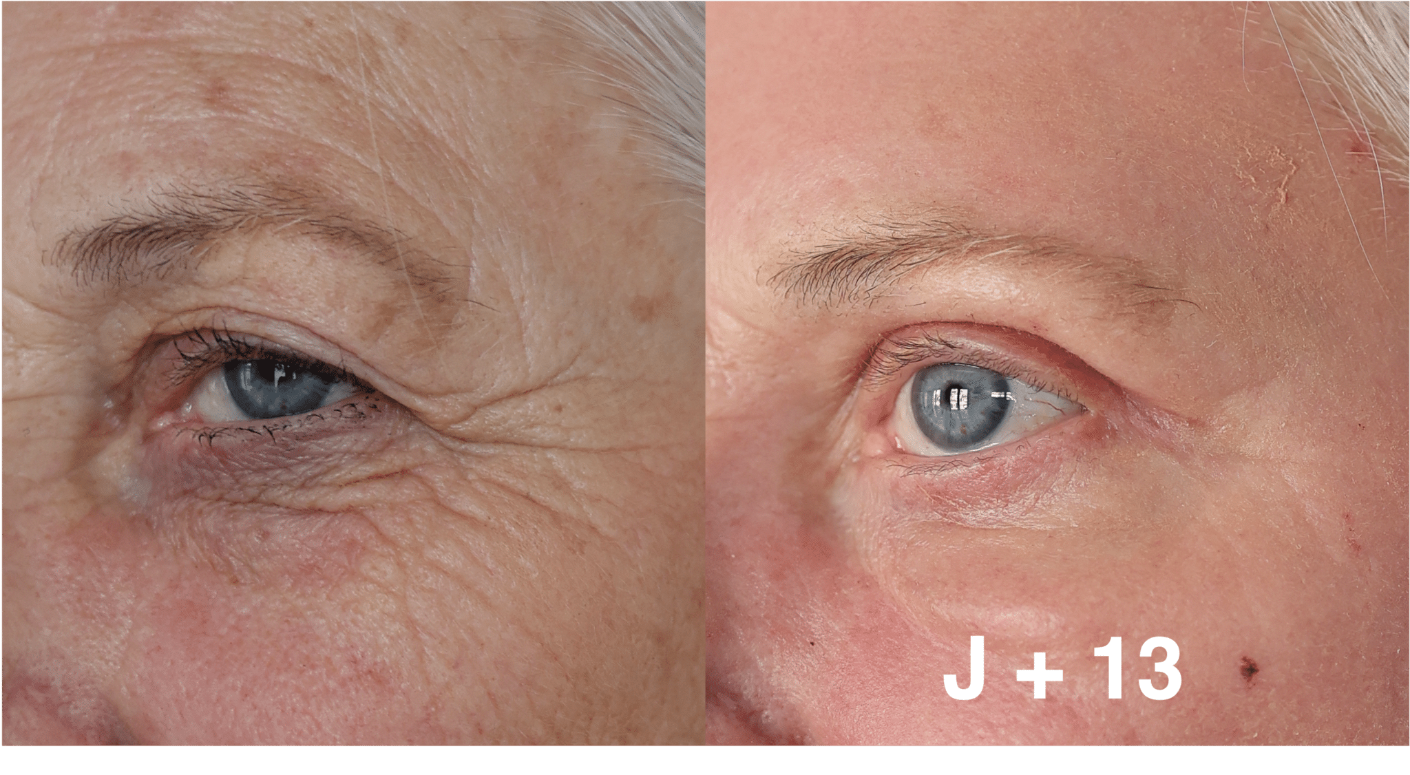 Blépharoplastie Laser : chirurgie des paupières au laser à Paris ...