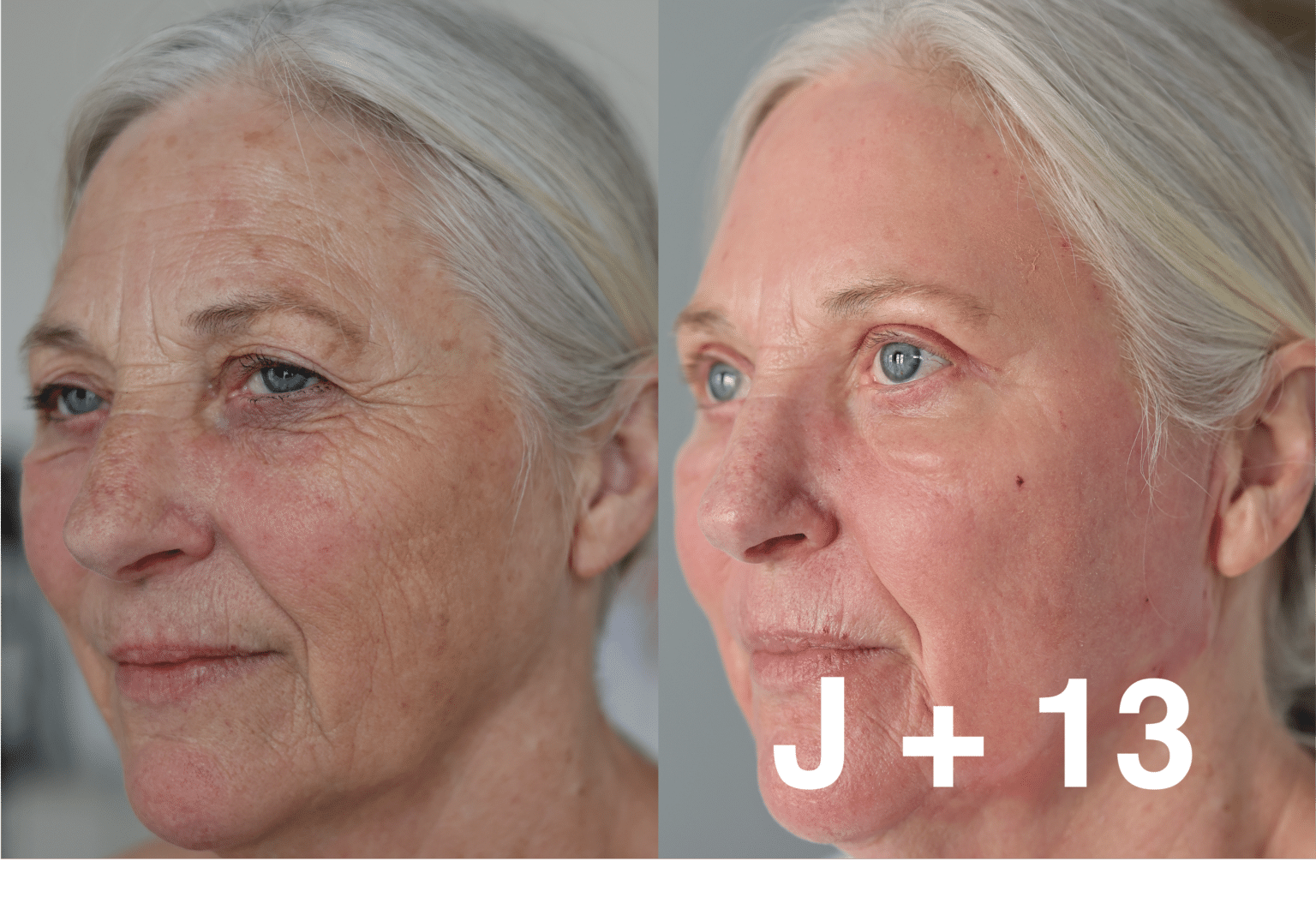 Laser CO2 Avant Après | Dermatologue Esthétique | Skin Marceau