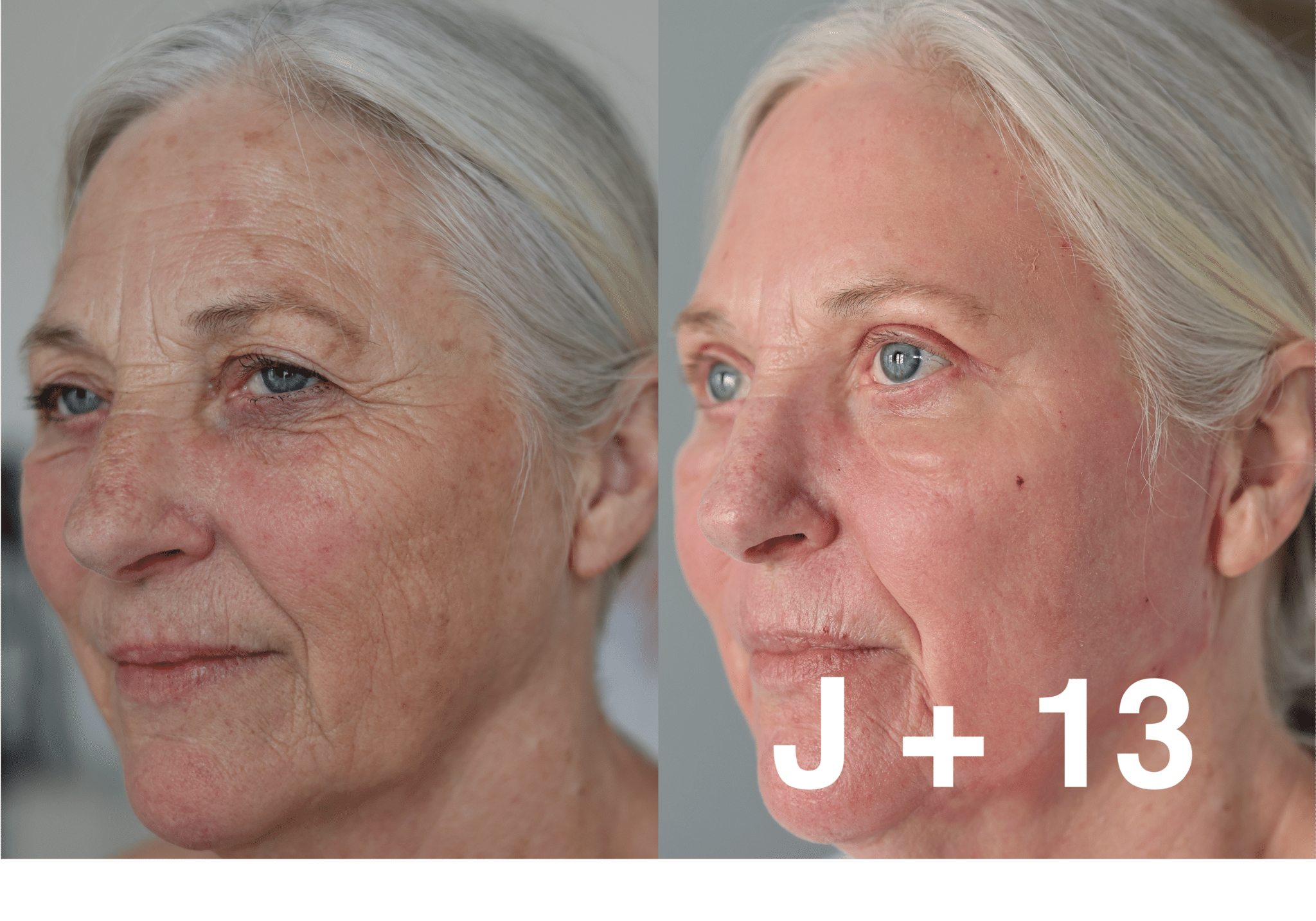 Laser CO2 Avant Après | Dermatologue Esthétique | Skin Marceau